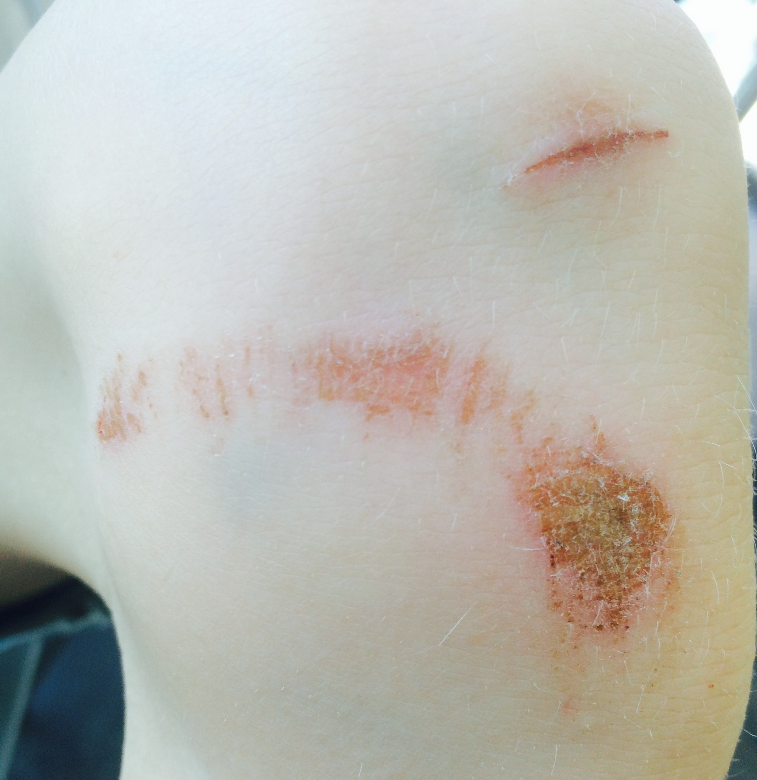 Biafine Cream @ Burns /not food/ – MESUBIM